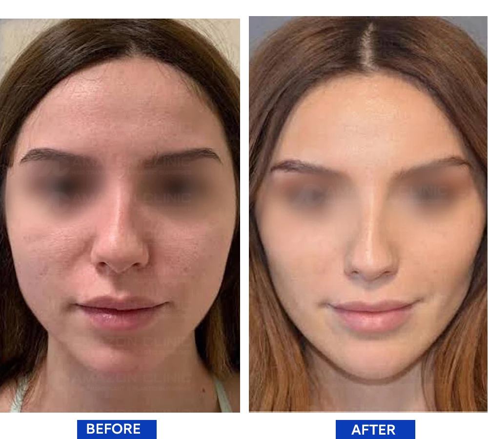 Bichectomy: Enhancing the Beauty of Your Cheeks