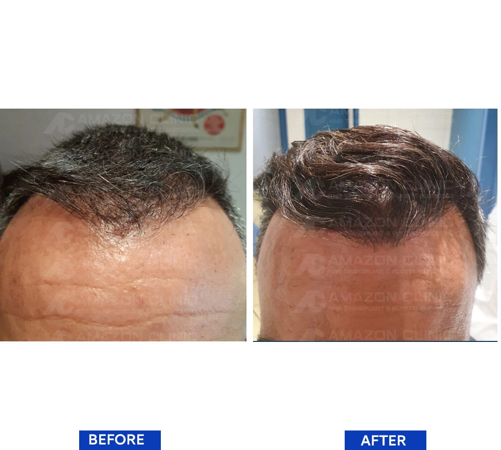 Direct Hair Implantation (DHI) Transplant