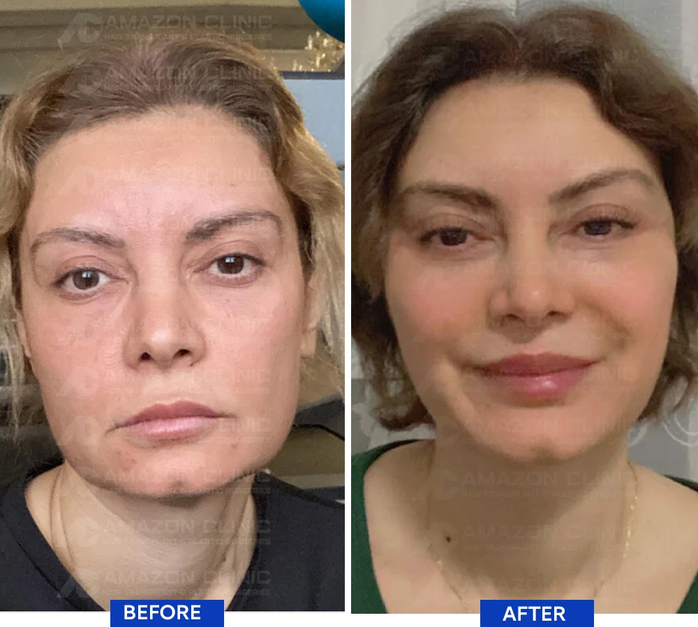 Your Guide to Face Lift Surgery, Techniques and Results