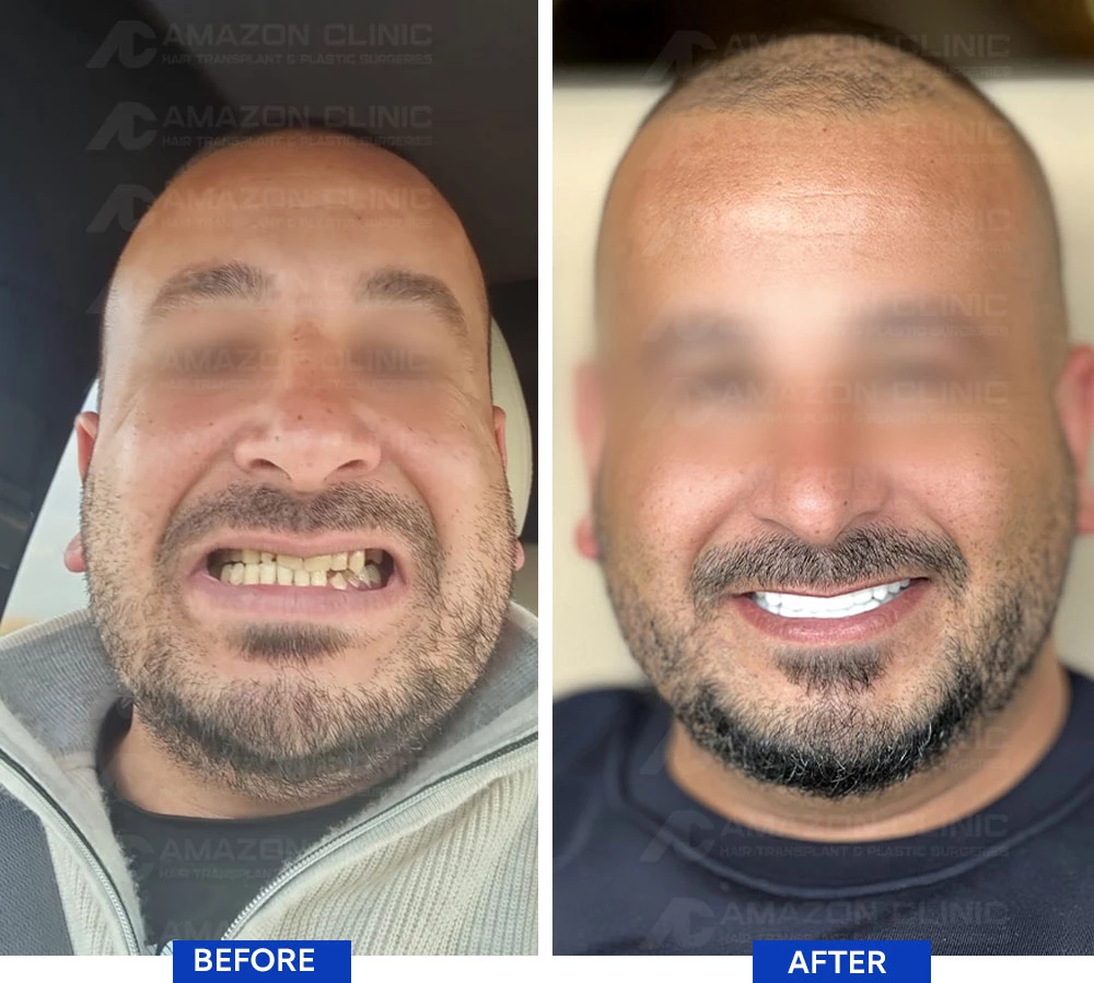 Transforming Your Smile by Hollywood Smile Procedure