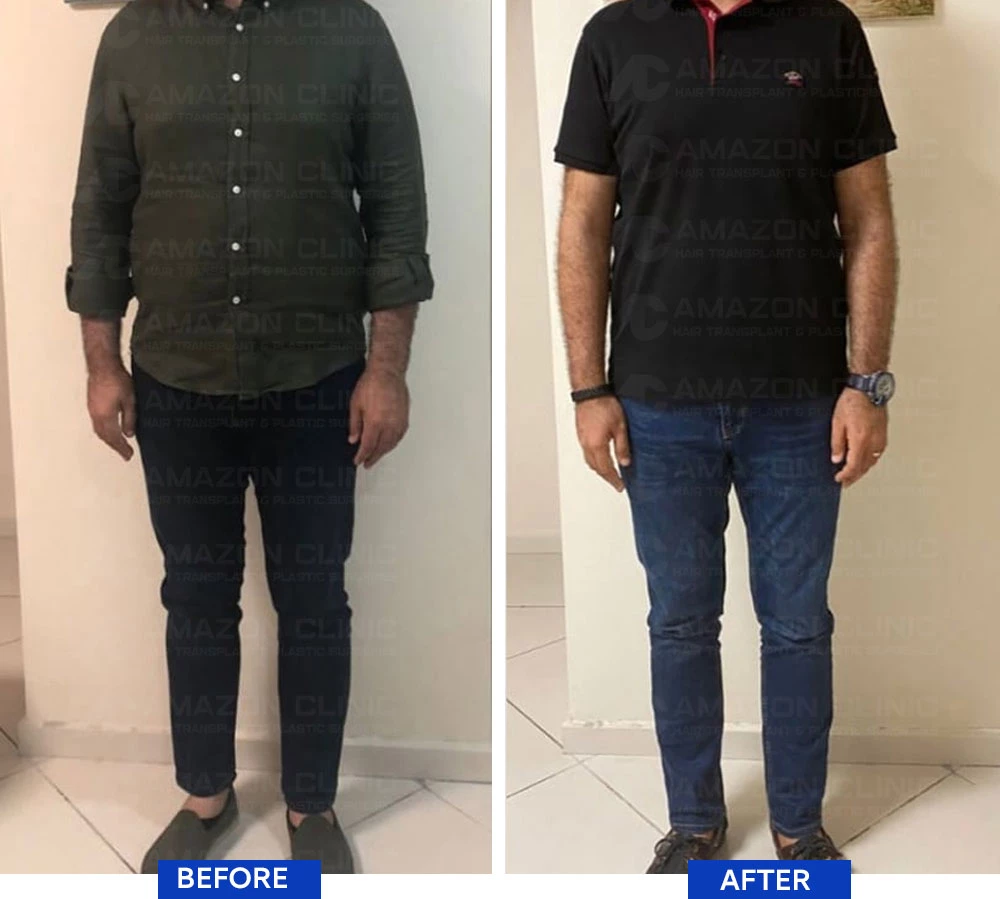 Gastric Botox: The Non-Surgical Solution for Weight Loss